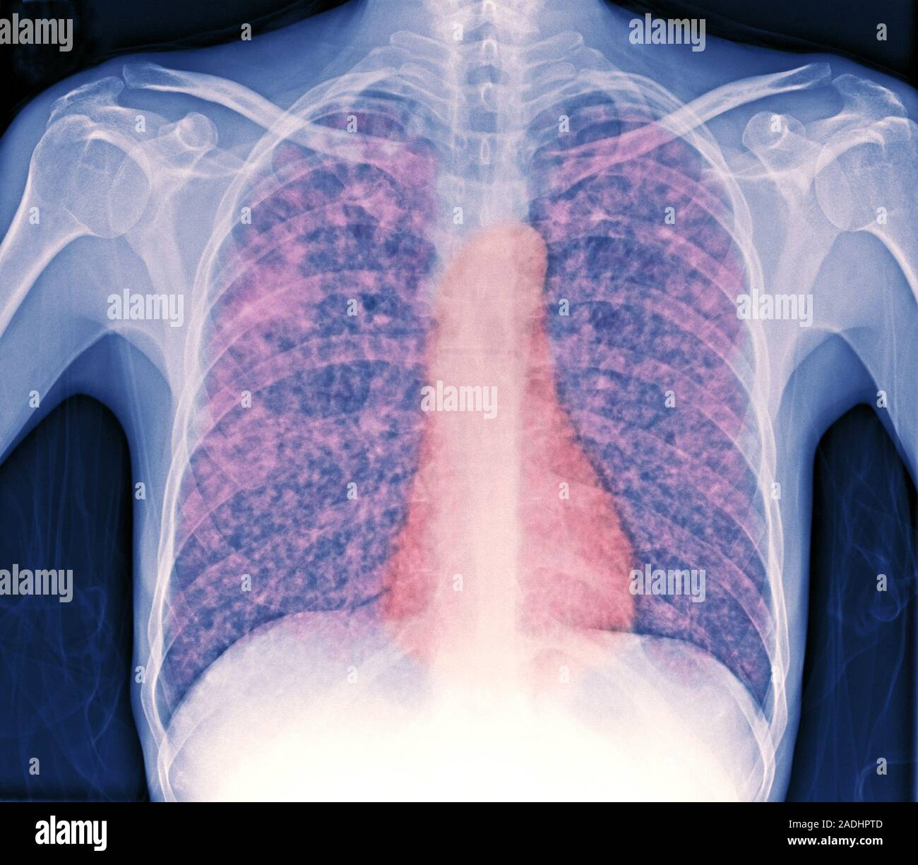 Disseminated Tb Immune Reconstitution Inflammatory Syndrome In A Child