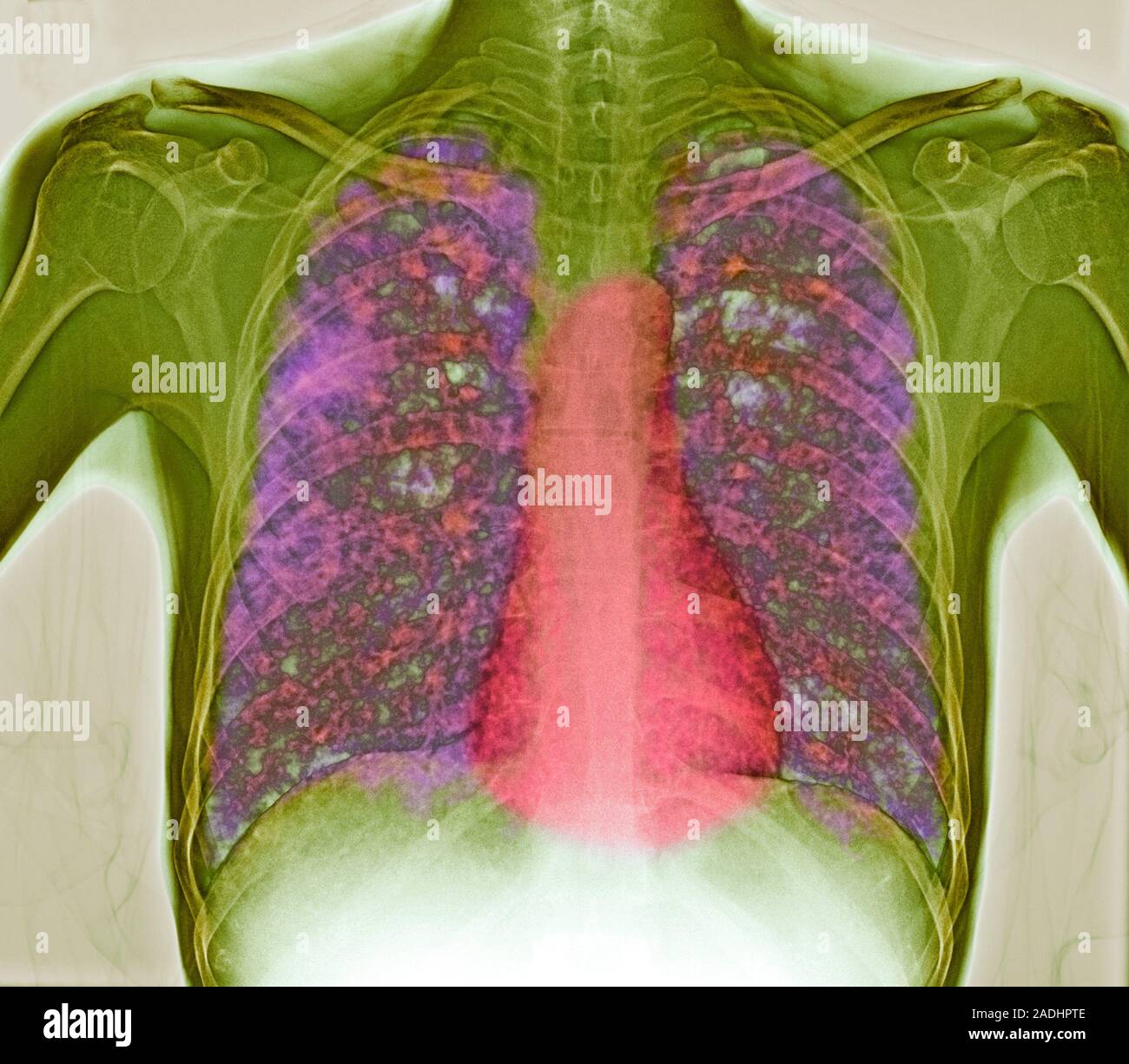 Tuberculosis. Coloured X-ray of a patient's chest showing disseminated ...