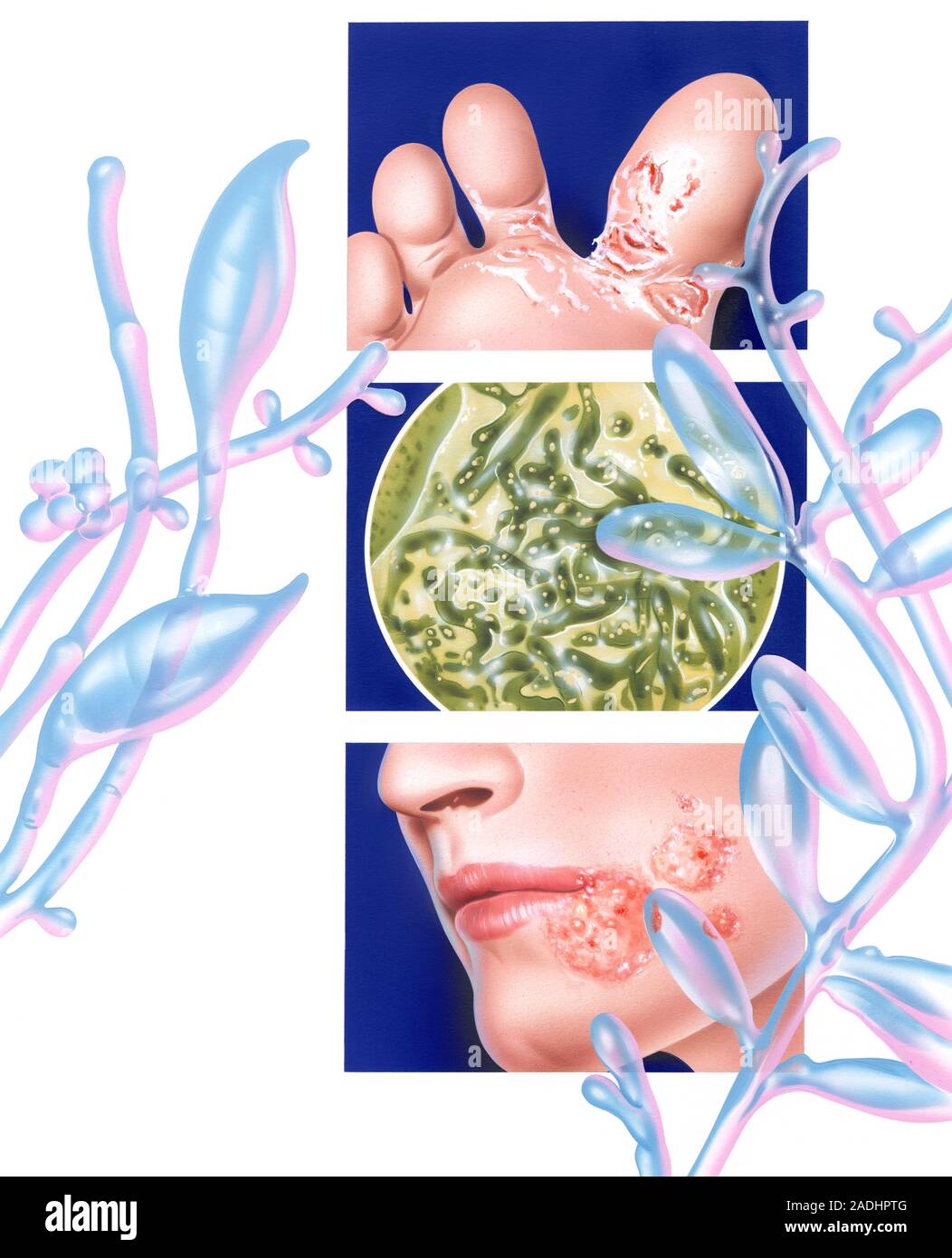 Fungal infections. Artwork of fungi (magnified in foreground, blue; and ...