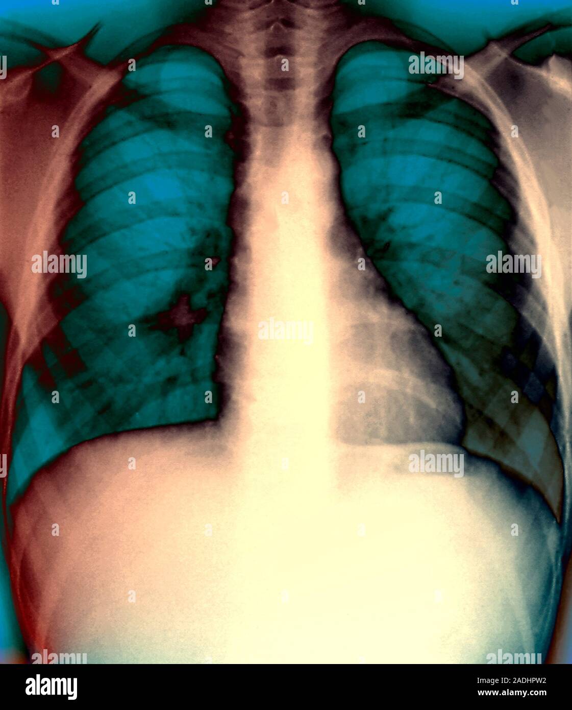 Tuberculosis. Coloured X-ray of the chest of a patient with primary ...