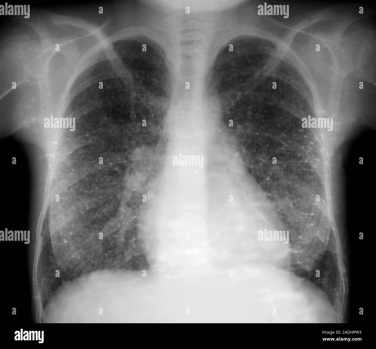 Miliary tuberculosis. X-ray of the chest of a patient with miliary ...