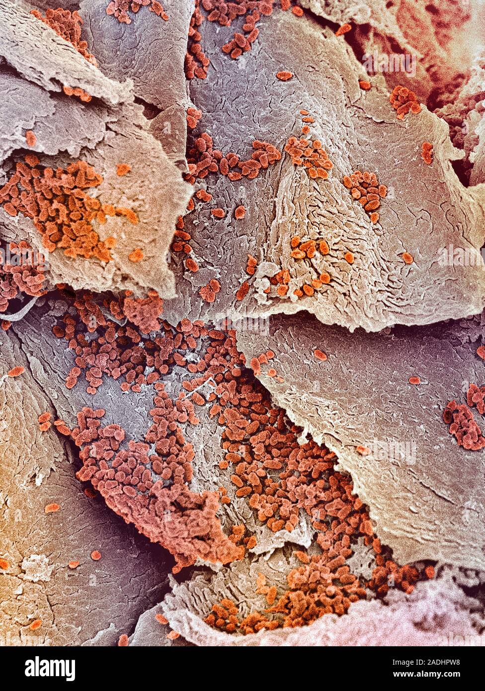 Bacterial infection of a nail. Coloured scanning electron micrograph ...