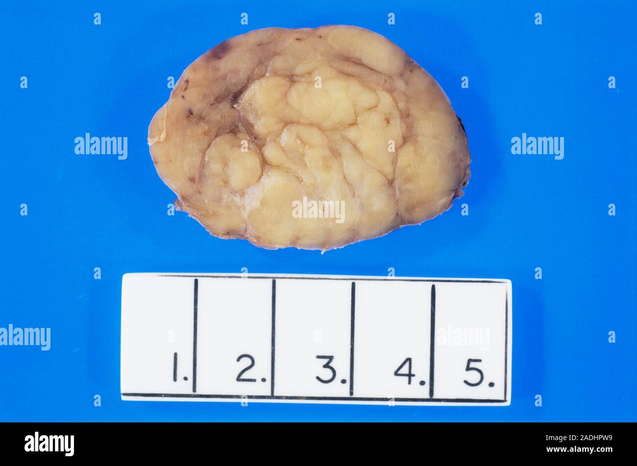 Thyroiditis (Hashimoto's disease). Gross specimen of an enlarged ...
