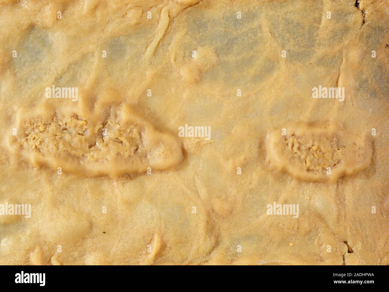 Intestinal ulcers. Gross specimen showing two ulcers (oval) in the wall ...