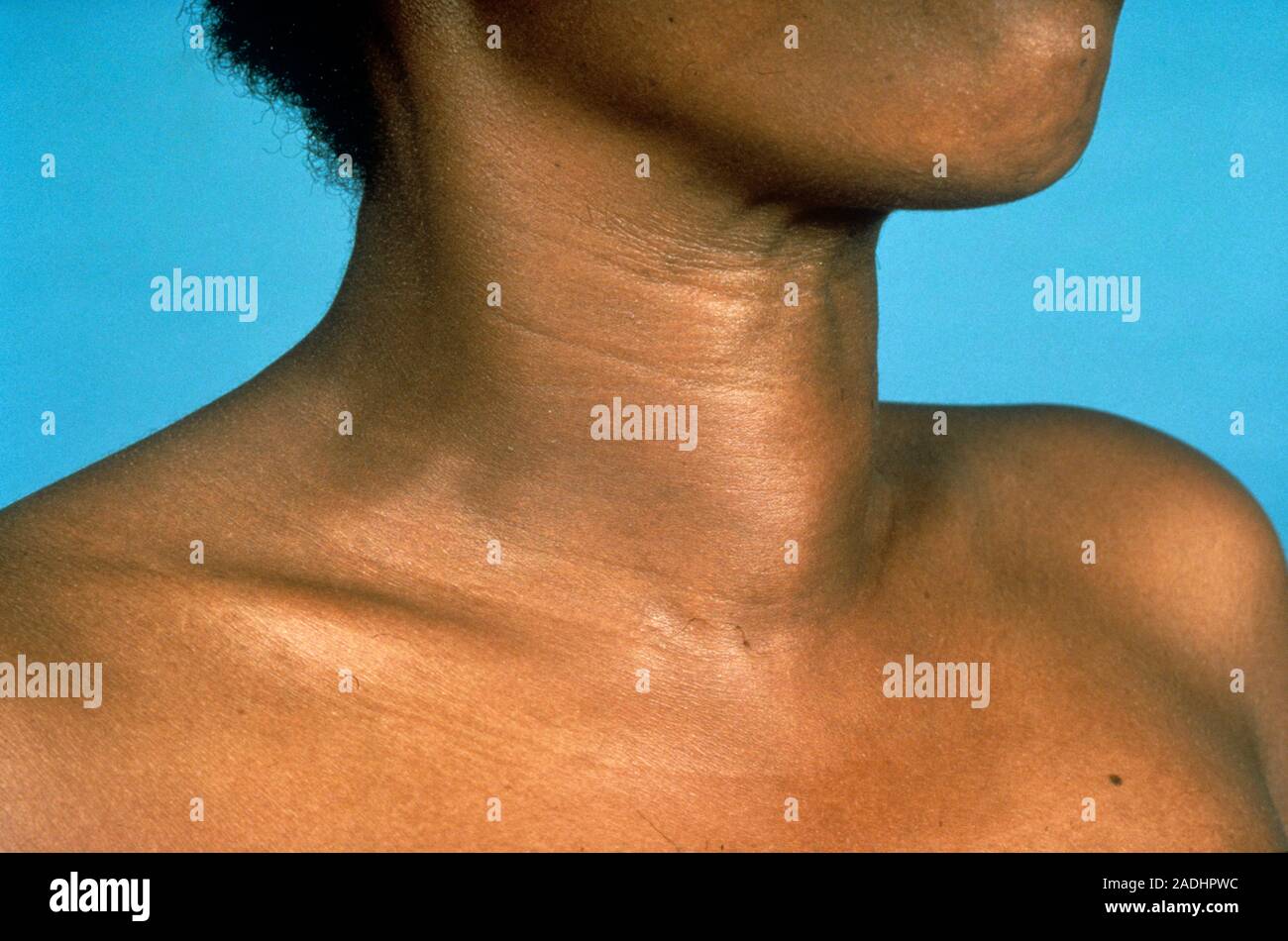 Thyroiditis (Hashimoto's disease). Patient with an enlarged thyroid ...