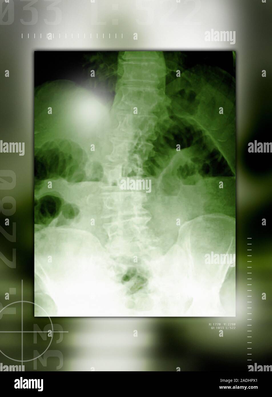 Bloated abdomen in tympanites, coloured X-ray. Tympanites is swelling ...