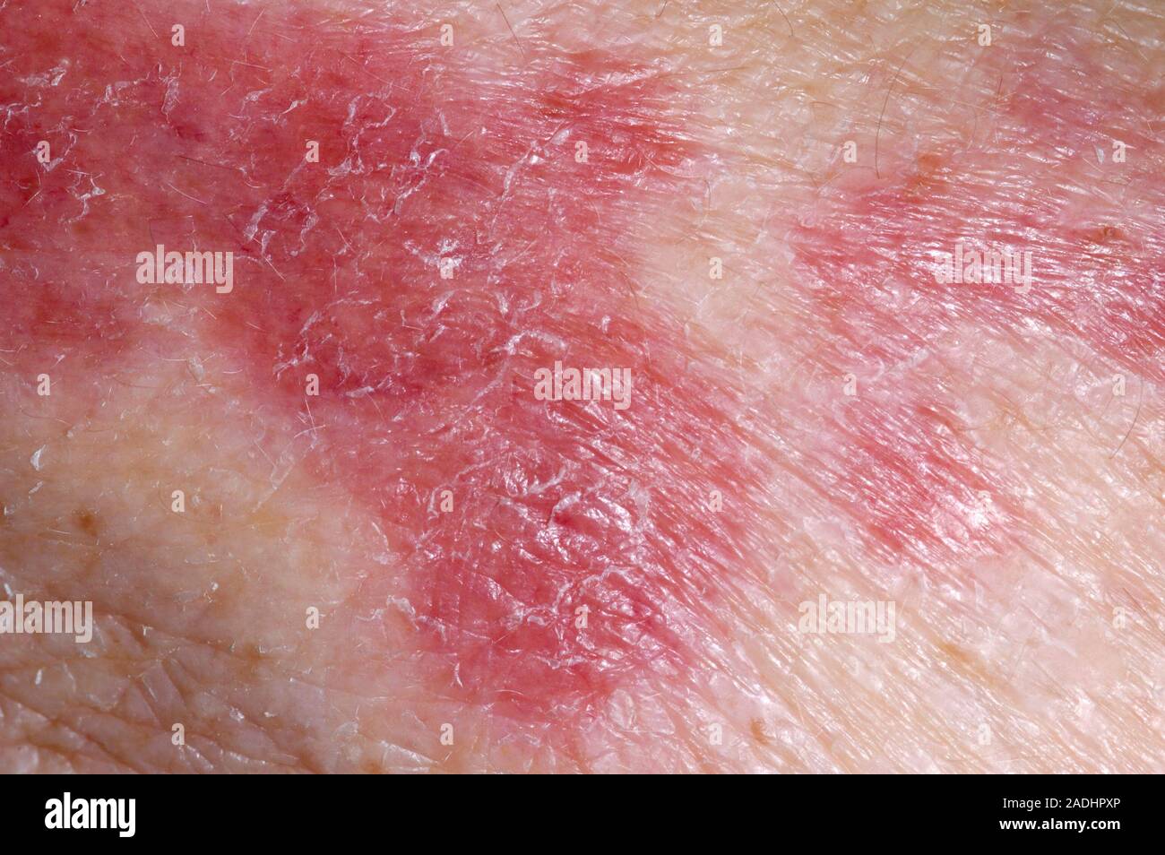 Cutaneous tuberculosis. Close-up of the skin of a 71 year old woman ...