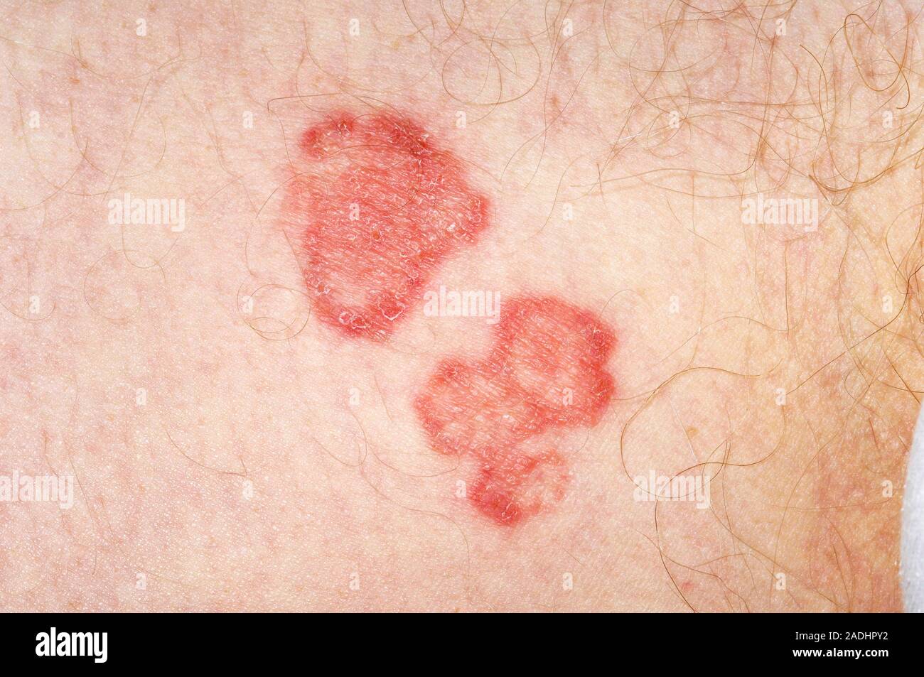 Ringworm infection on a 60 year old man's groin. A ringworm (tinea ...