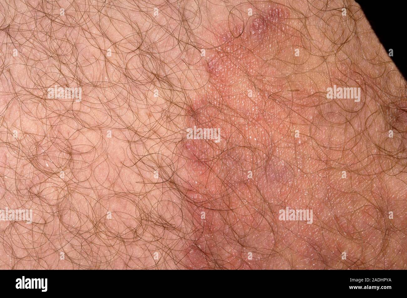 Ringworm Fungal Infection Dark Area At Right On The Skin Of A 69 Year Old Mans Groin