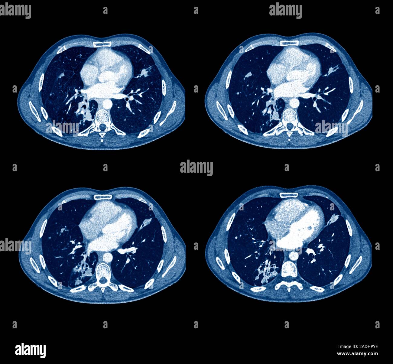 Tuberculosis. Coloured axial computed tomography (CT) scans of sections through the chest of a ...