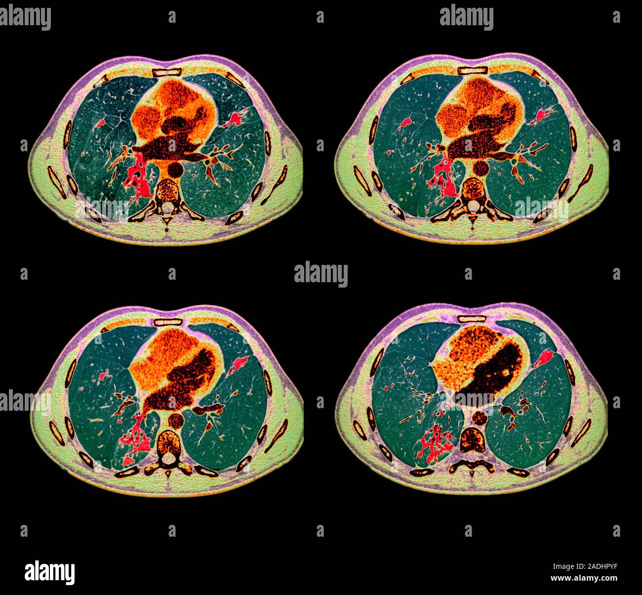 Tuberculosis. Coloured axial computed tomography (CT) scans of sections through the chest of a ...