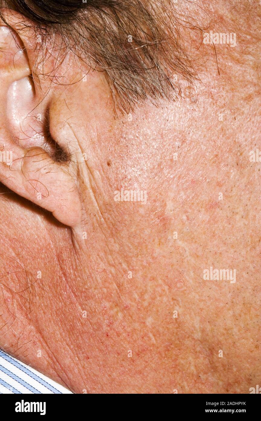 MODEL RELEASED. Tuberculosis. 67 year old man with a swollen pre ...