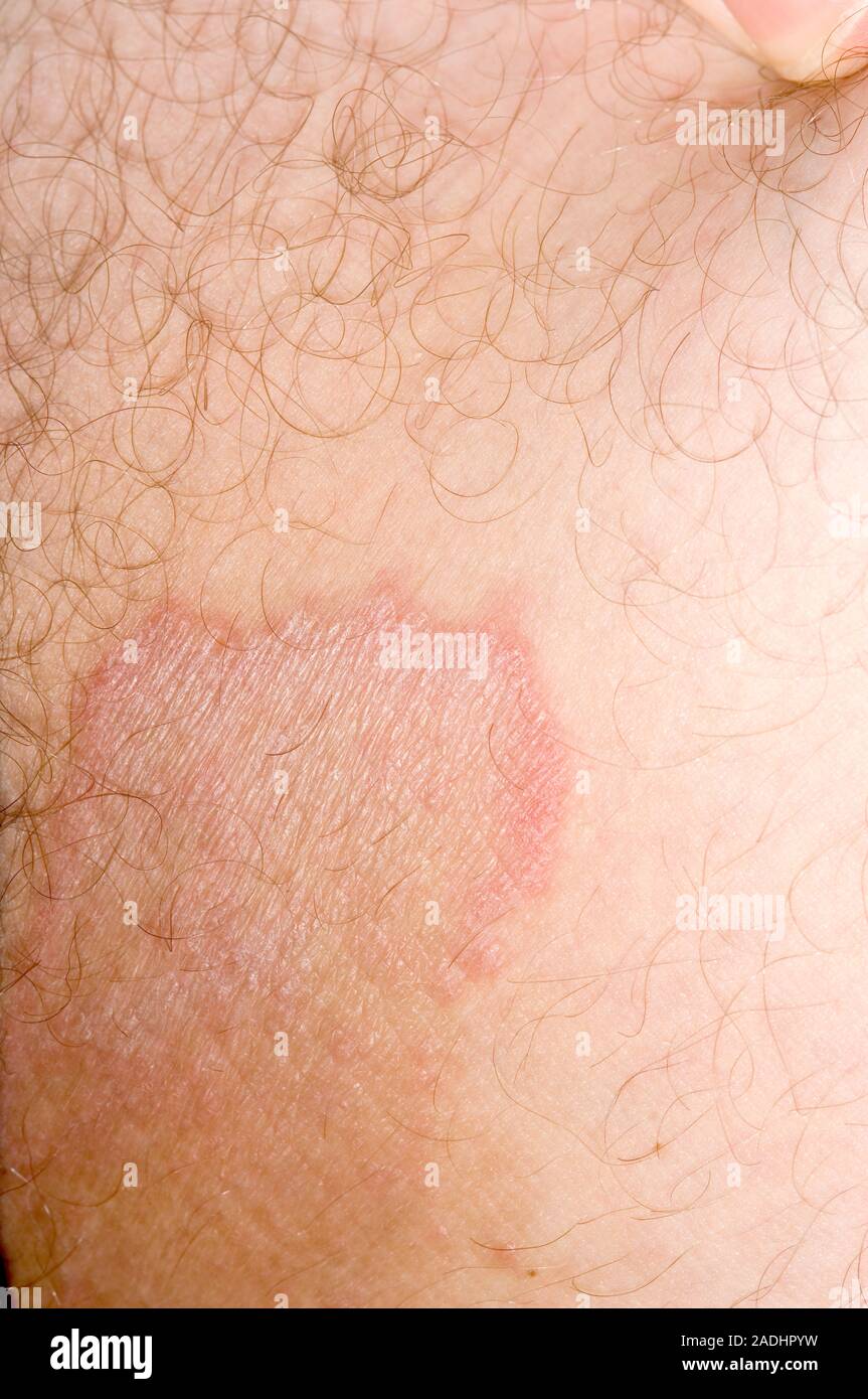 MODEL RELEASED. Ringworm infection on a 22 year old man's groin. A ...