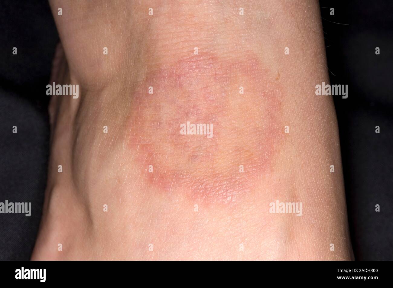 Ringworm infection (tinea) on the back of a 30-year-old woman's ankle ...