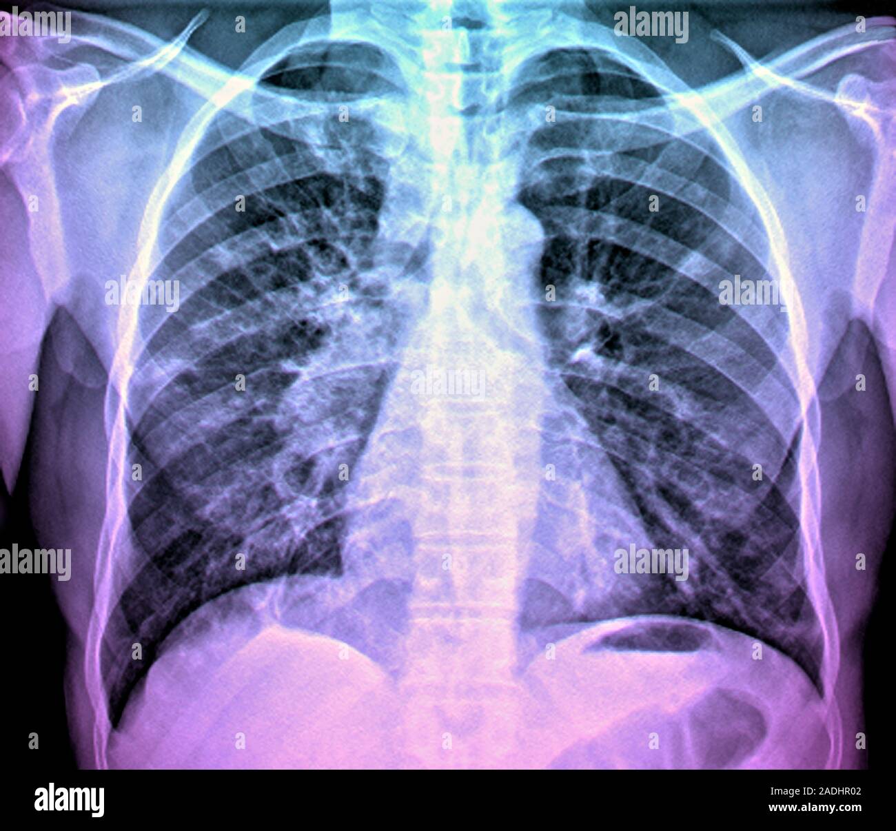 Tuberculosis pneumonia. Coloured X-ray of the chest of a 46 year old ...