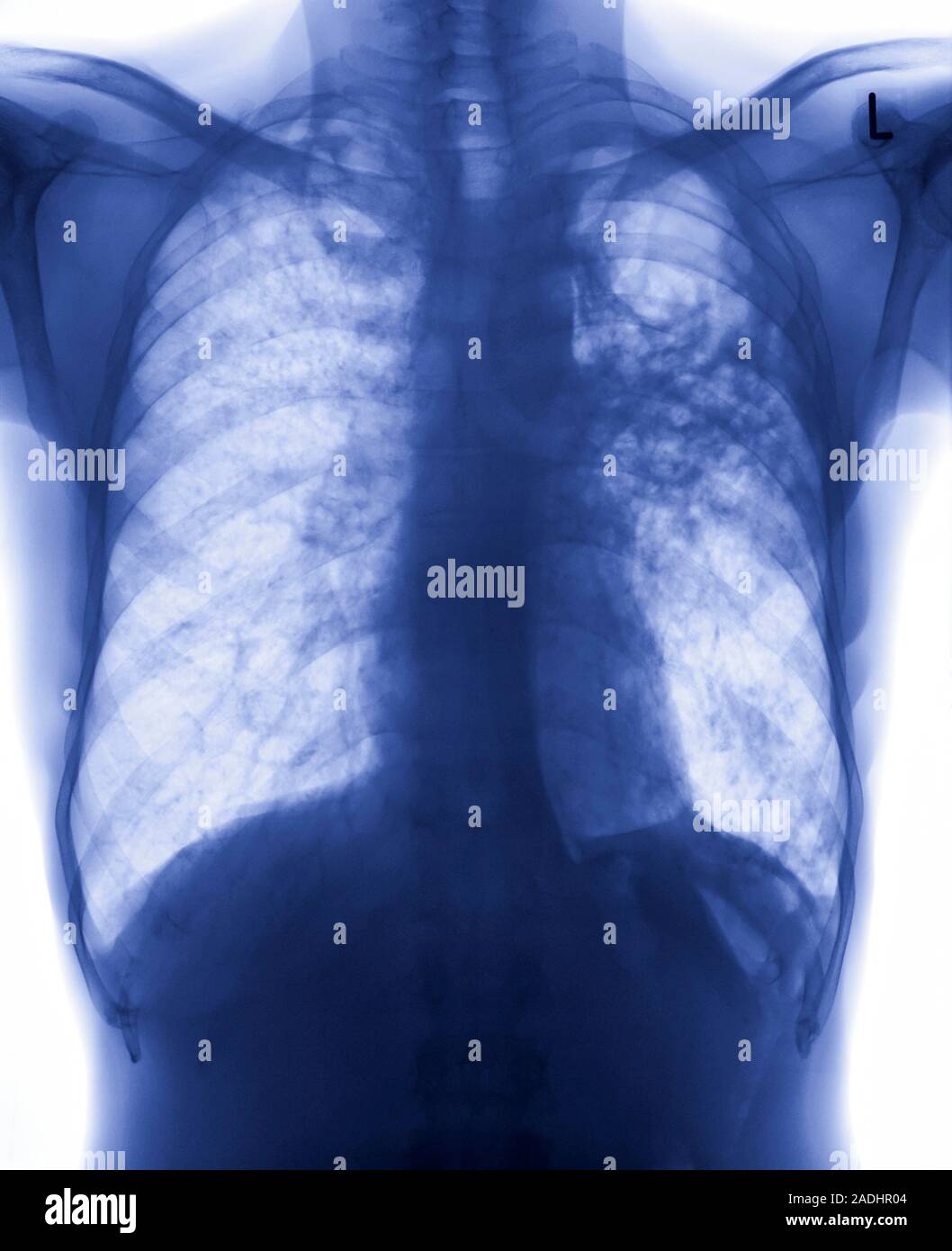 Tuberculosis. Coloured X-ray of the chest of a male patient with ...