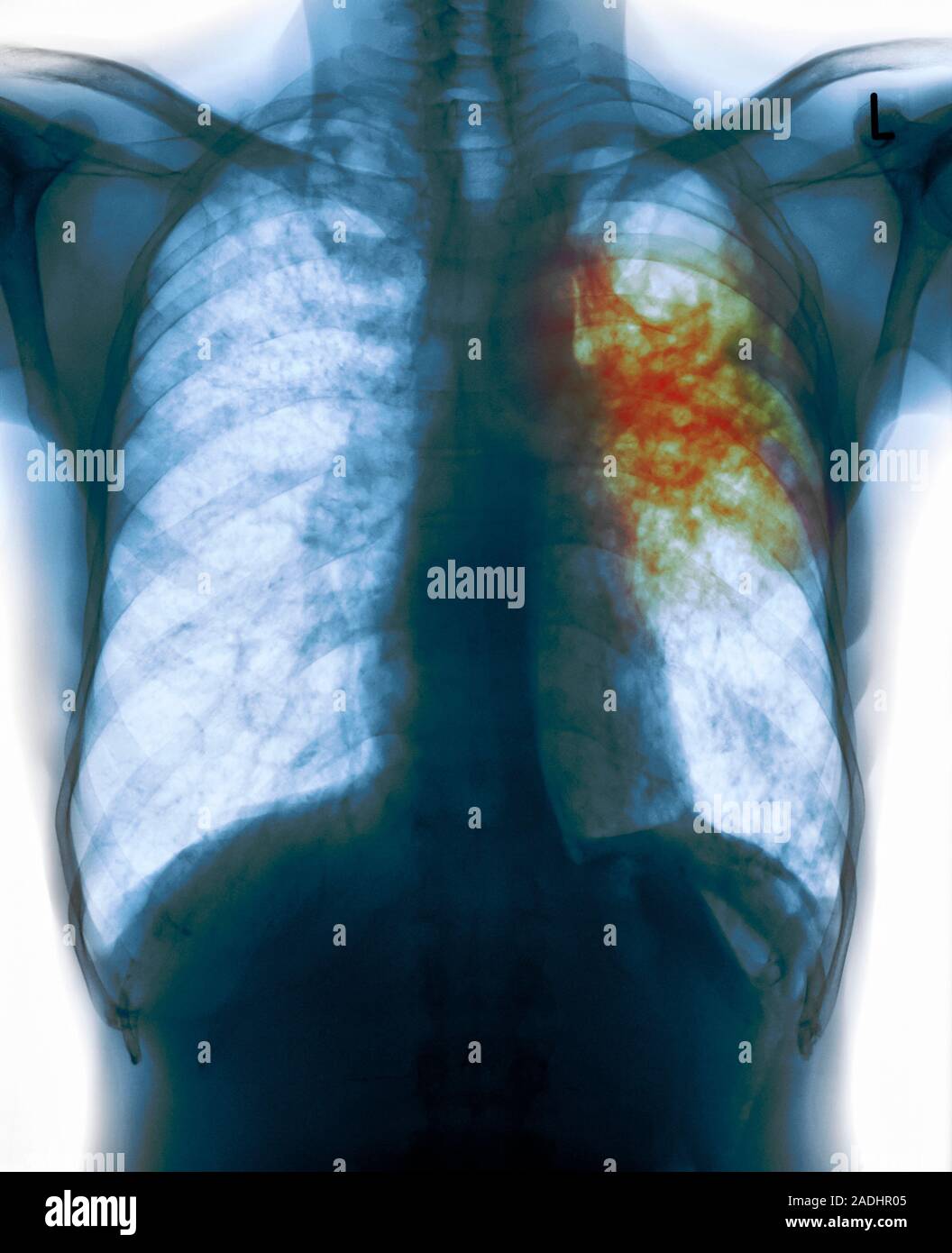 Tuberculosis. Coloured X-ray of the chest of a male patient with ...