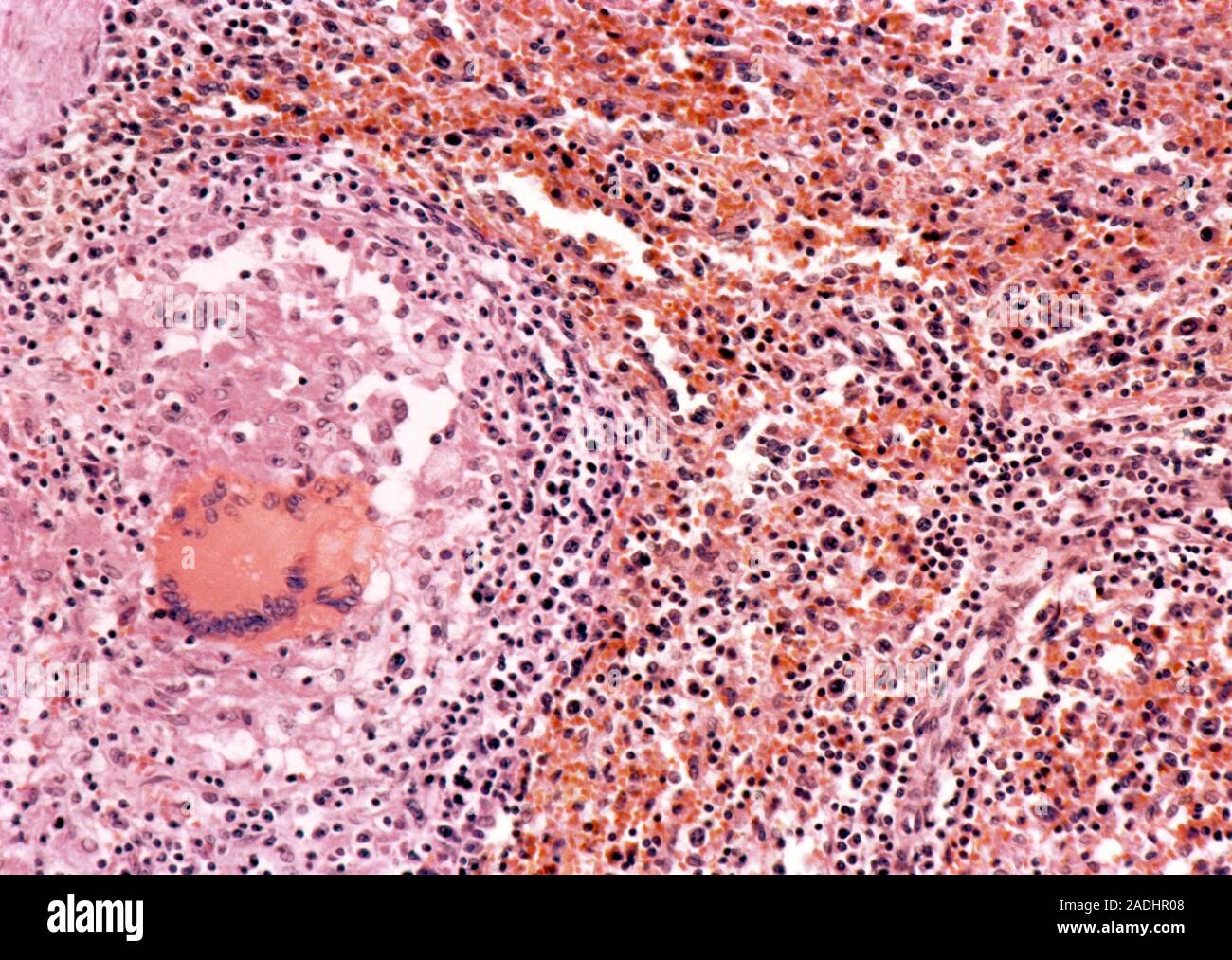 Miliary tuberculosis. Light micrograph of a section through a single ...