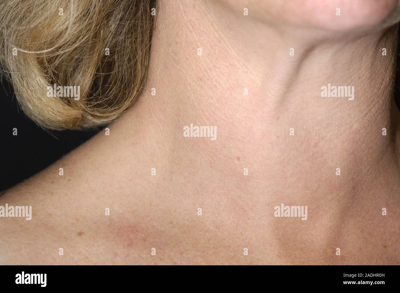 Swollen thyroid gland in the throat of a 41-year-old woman with ...