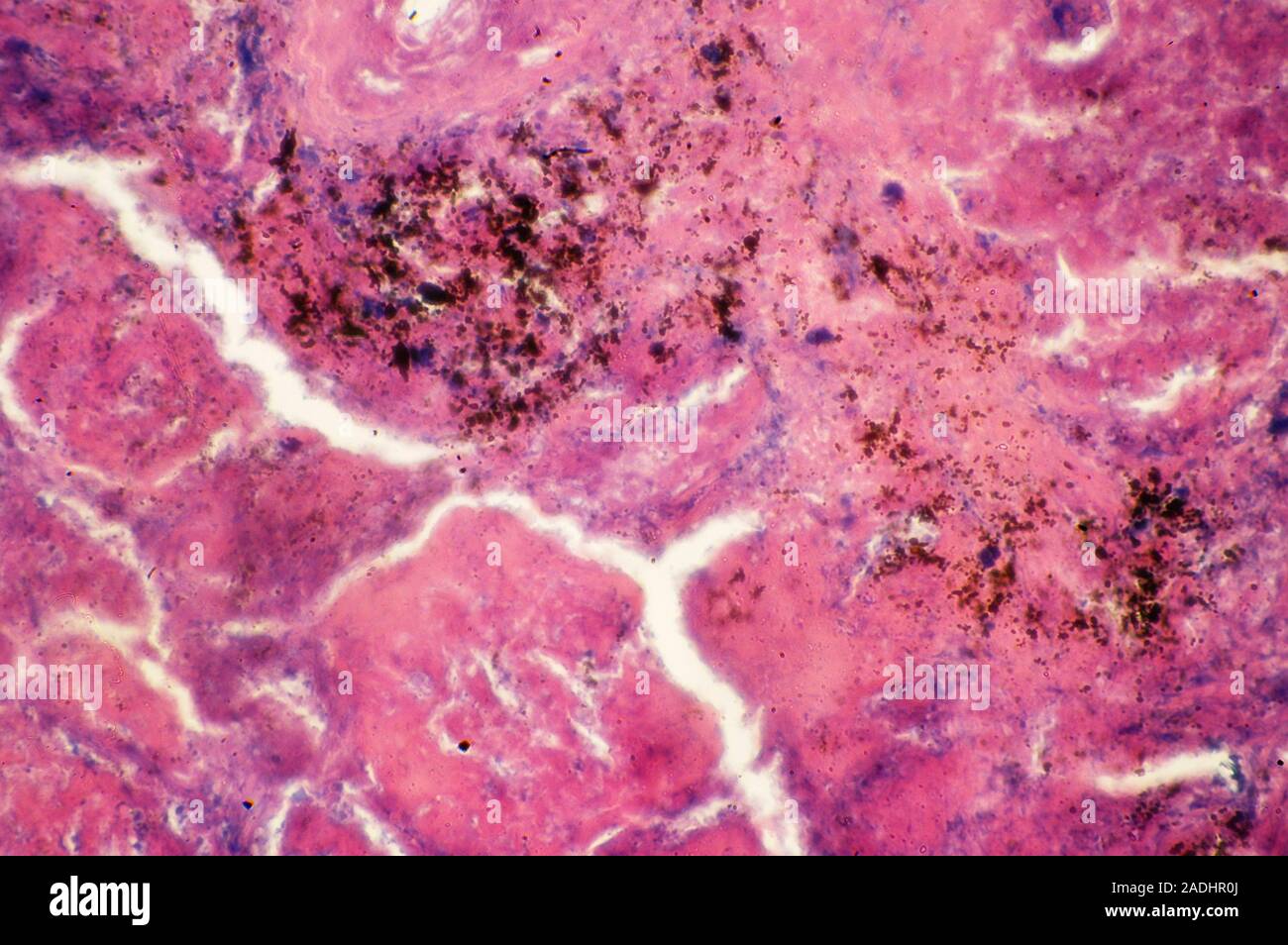 Pulmonary tuberculosis. Light micrograph of a section through lung ...