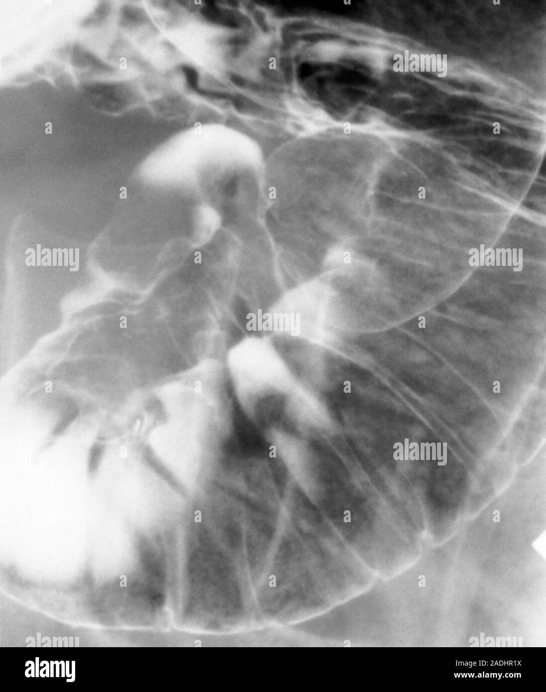 Double contrast X-ray showing a duodenal ulcer. The ulcer crater ...