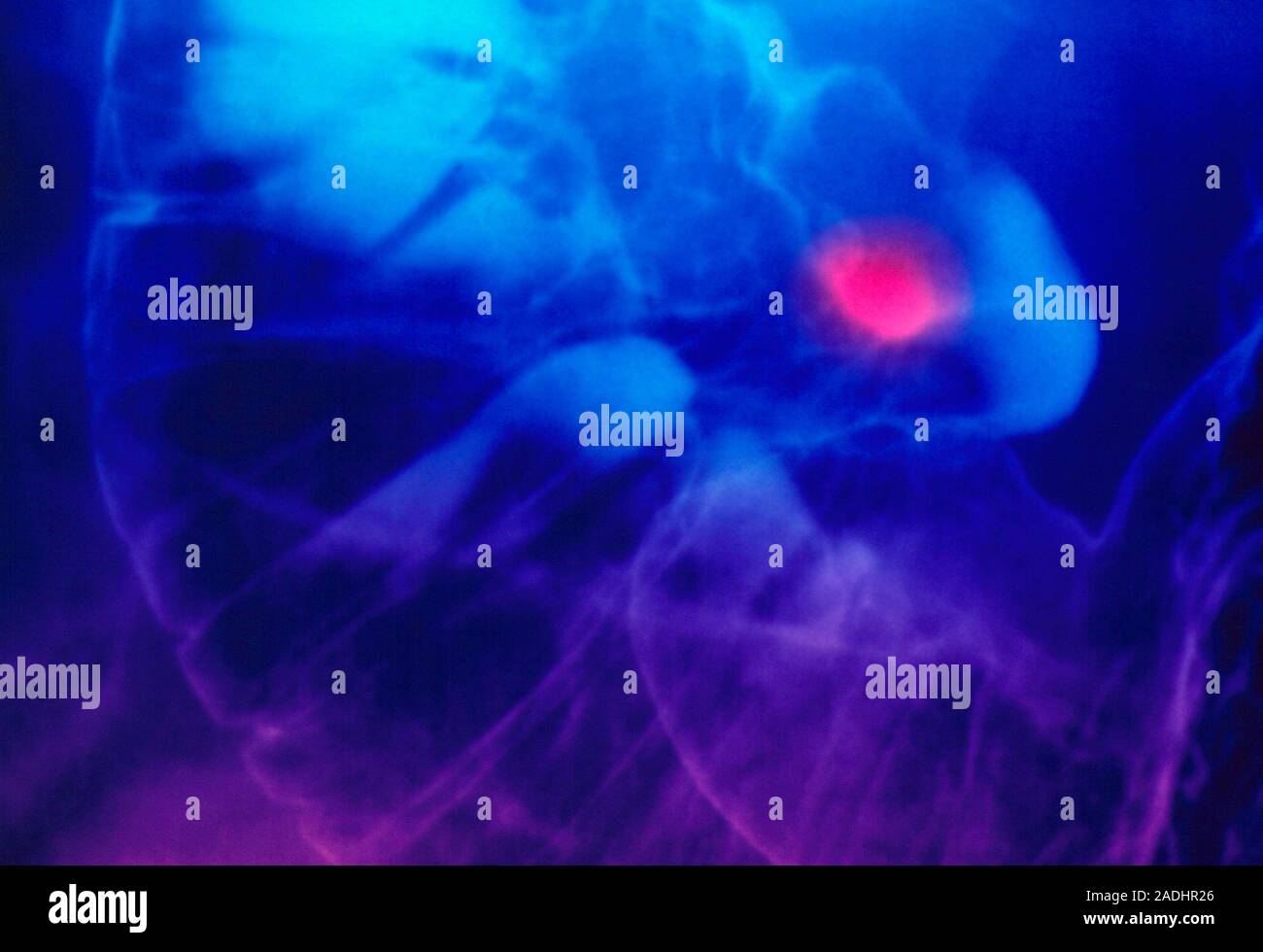 Ulcer. False-colour double contrast X-ray showing a duodenal ulcer. The ...