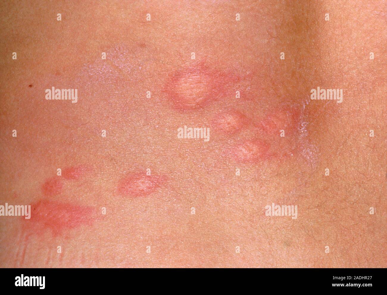 Urticaria skin rash (nettle rash or hives) affecting the back of a ...