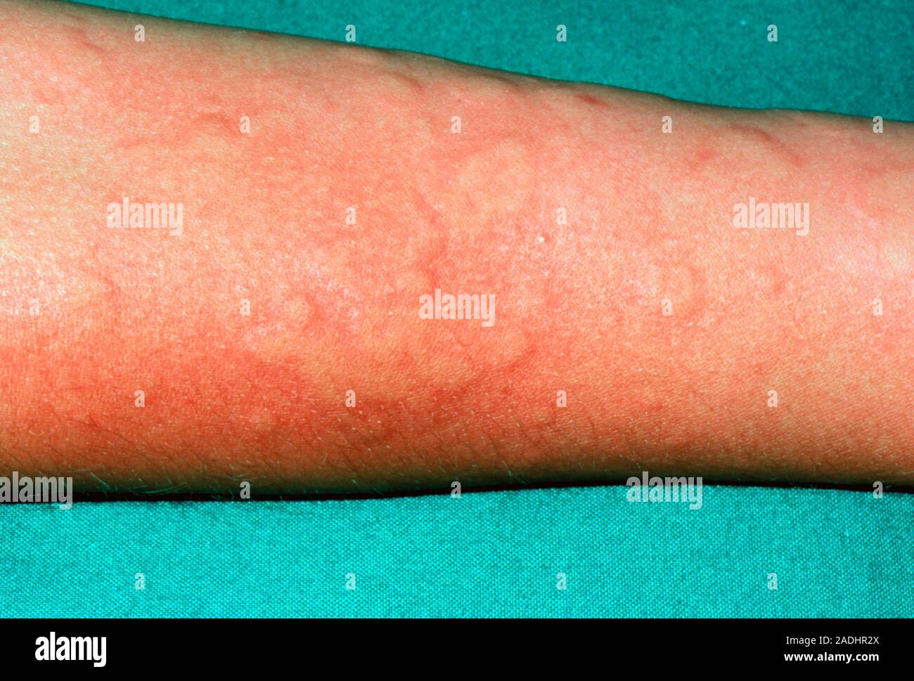 Allergic Reaction Rash On Arms Pictures Of Common Skin Rashes,