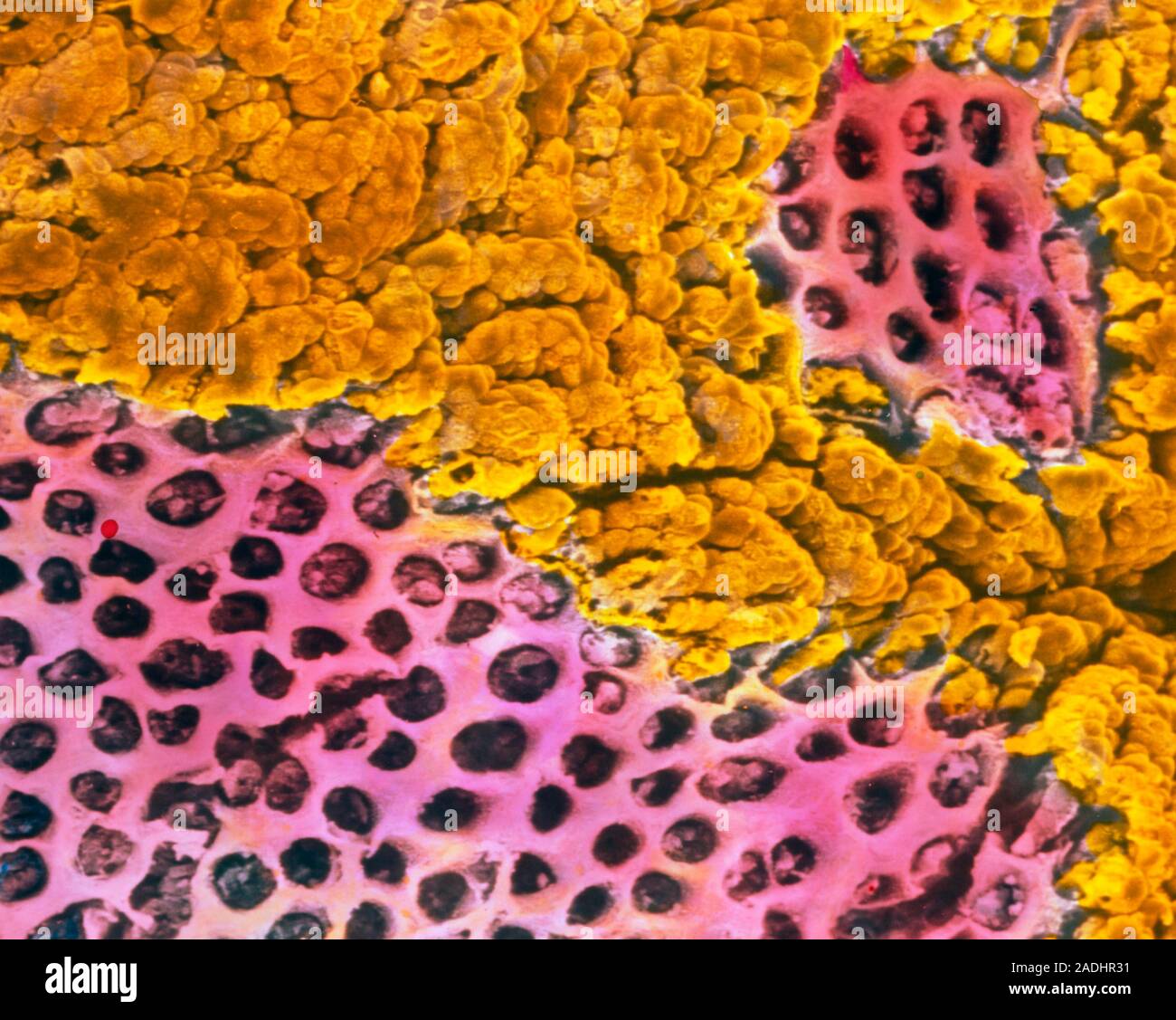 Gastric ulcer. Coloured scanning electron micrograph (SEM) of the human ...