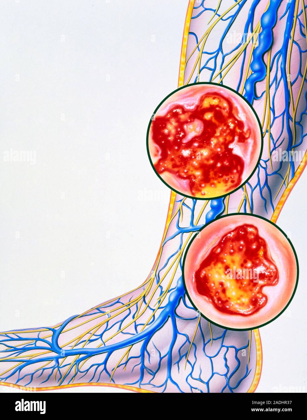 Varicose ulcers. Abstract illustration of varicose ulcers in a human ...