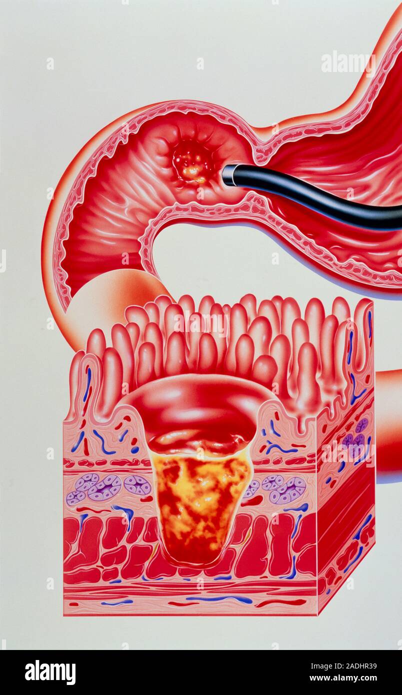 Peptic ulcer. Illustration of a peptic ulcer in the wall of the human ...