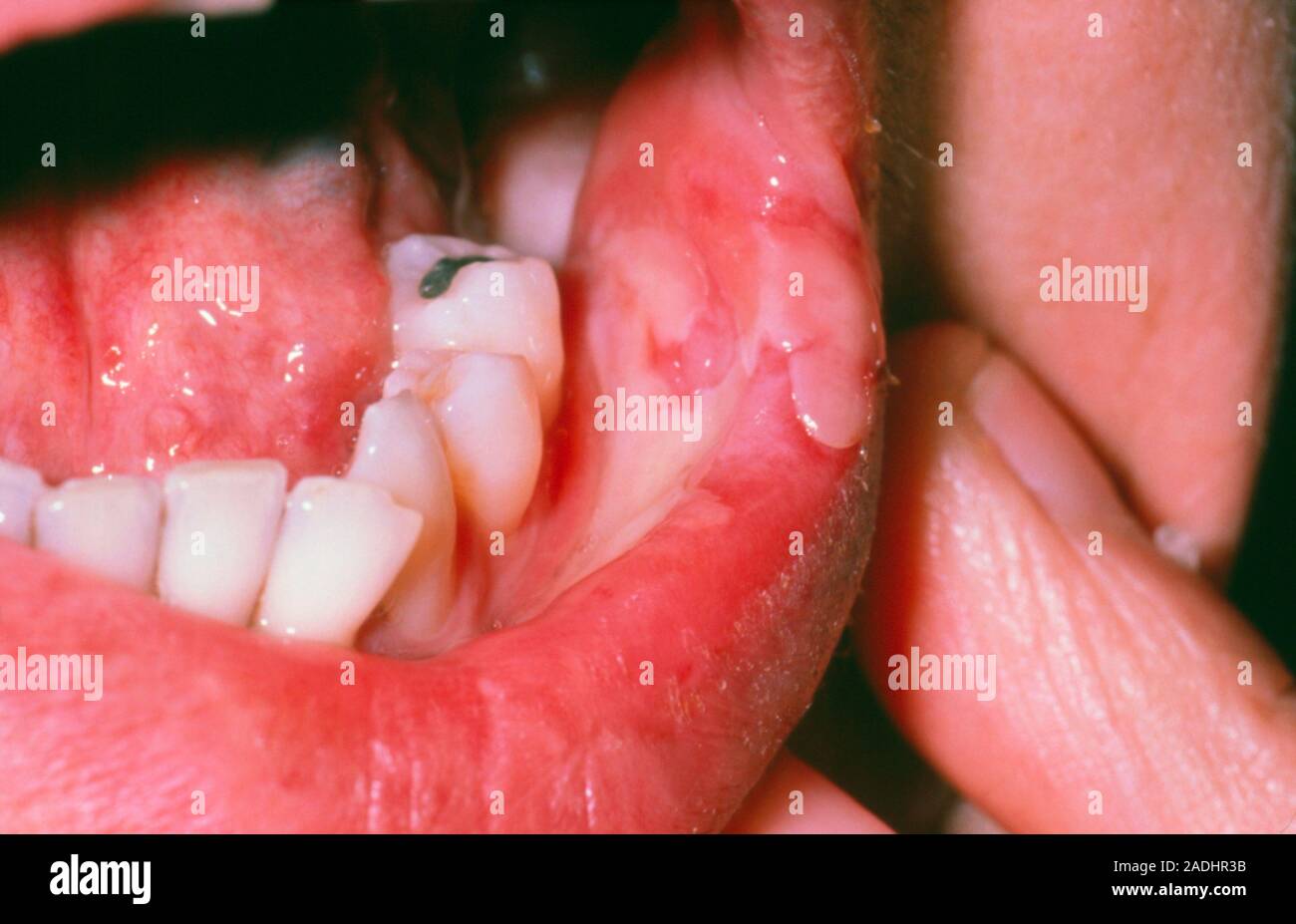 Aphthous Ulcer Close Up Of An Aphthous Ulcer Mouth Ulcer On The Inside Of Patients Lower Lip