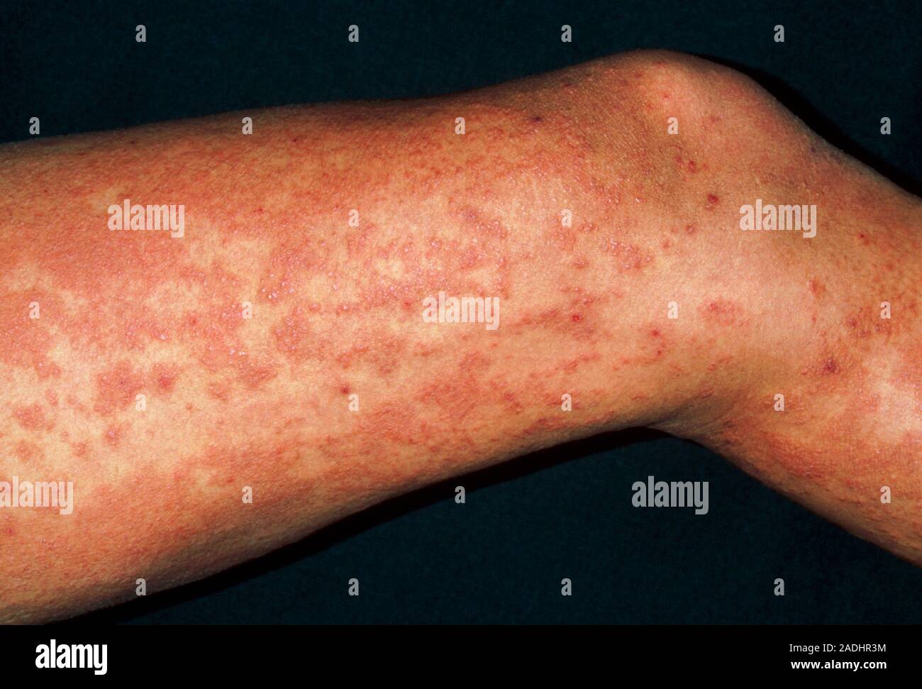 Urticaria on legs. Numerous small pink urticaria wheals on an 18 year ...