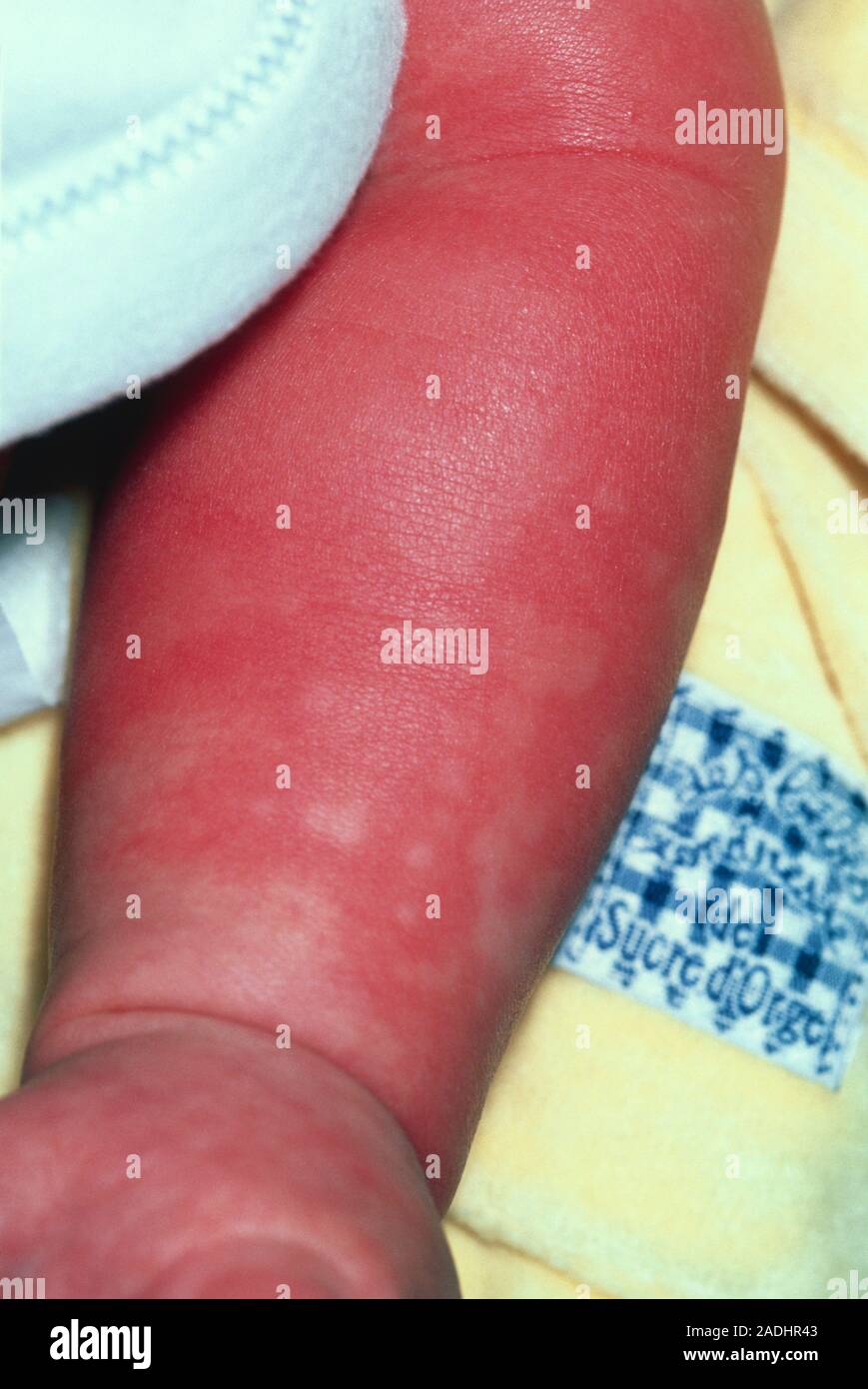 Urticaria. View of the arm of a three month old baby boy showing an ...
