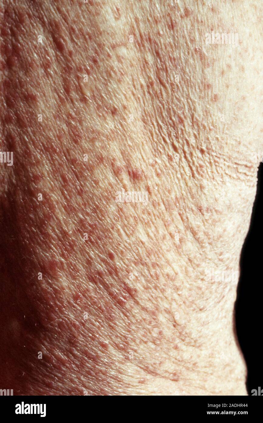 Urticaria. View of an urticaria rash on the skin of a 59 year old woman ...