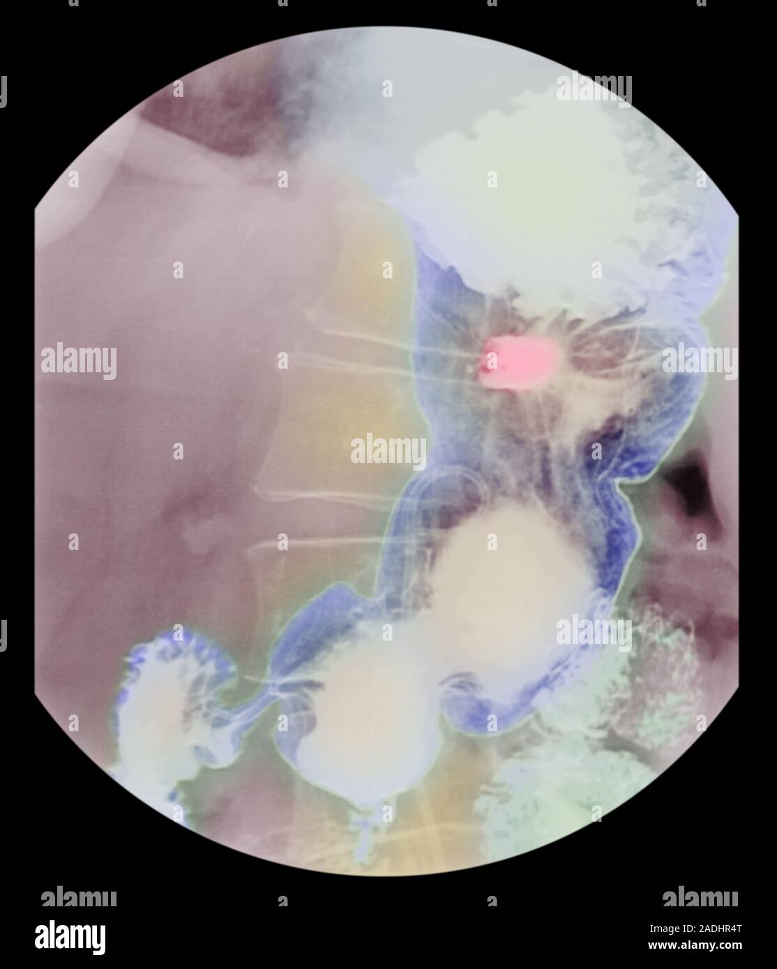Stomach ulcer. Coloured barium X-ray of a patient's stomach (blue/white ...