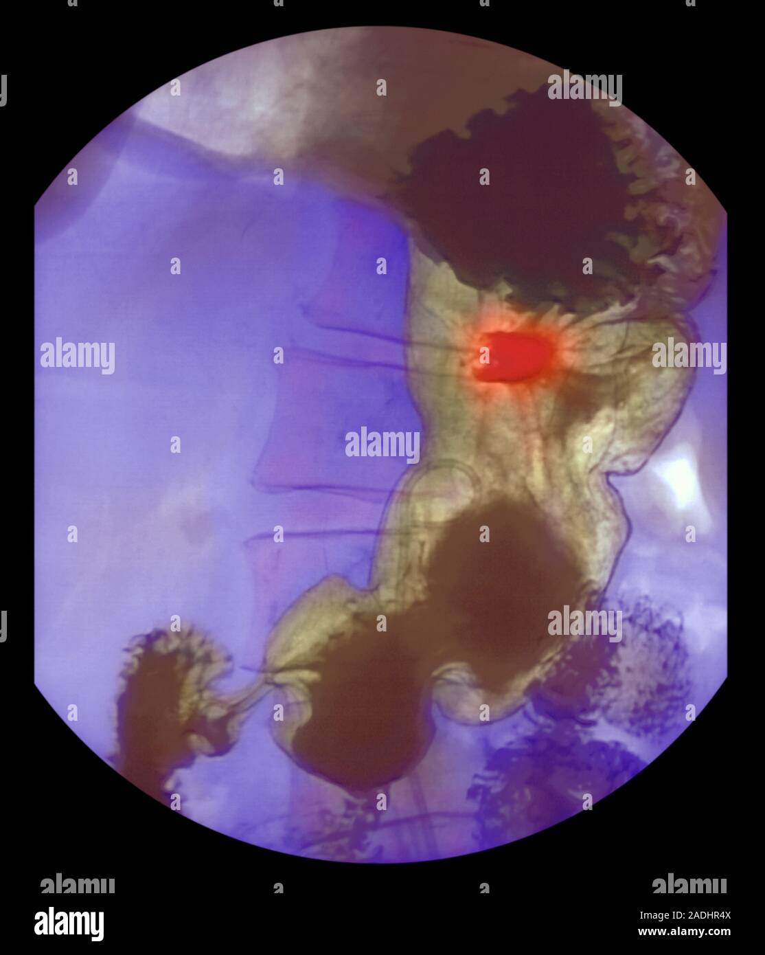 Stomach ulcer. Coloured barium X-ray of a patient's stomach (brown ...