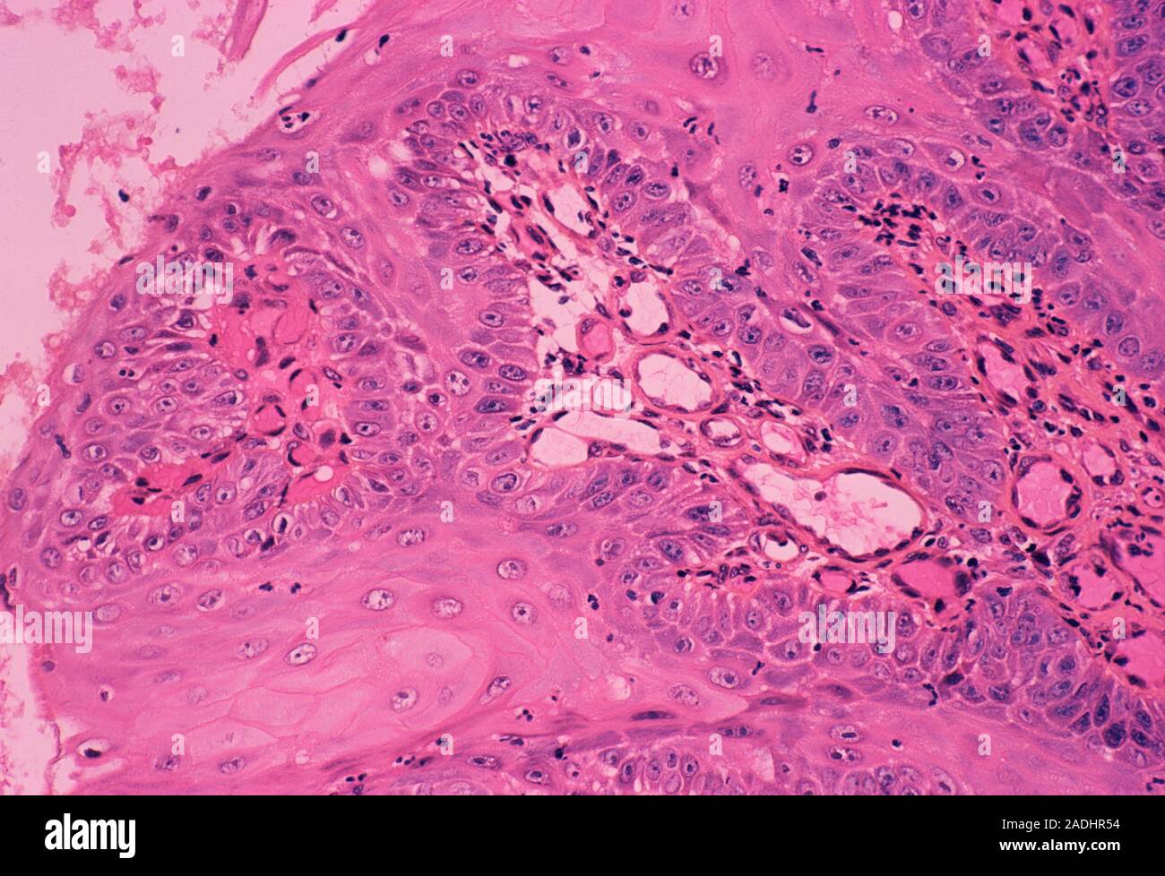 Peptic ulcer. Light micrograph of a cross section of the lower ...