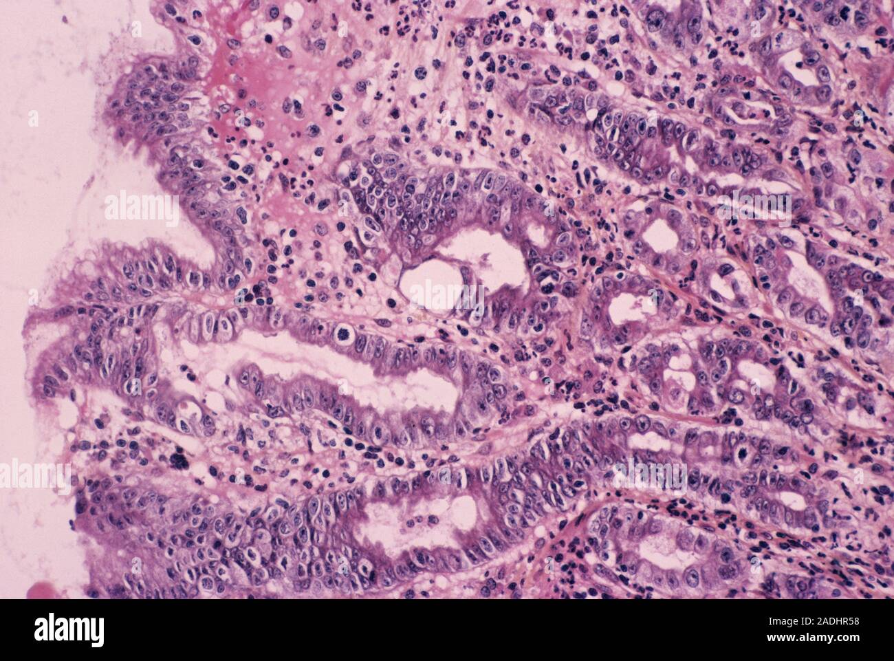 Gastric ulcer. Light micrograph of a section of the lining of the ...