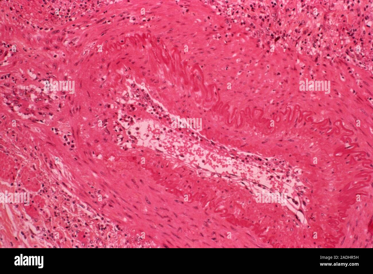Stomach ulcer. Light micrograph of a section of stomach tissue showing ...