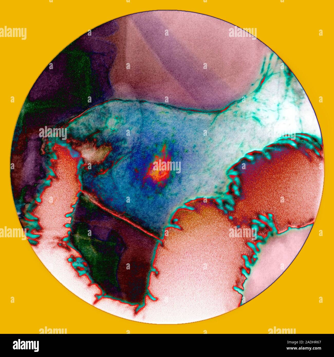 Stomach ulcer. Coloured barium X-ray of a gastric ulcer (red) in a ...