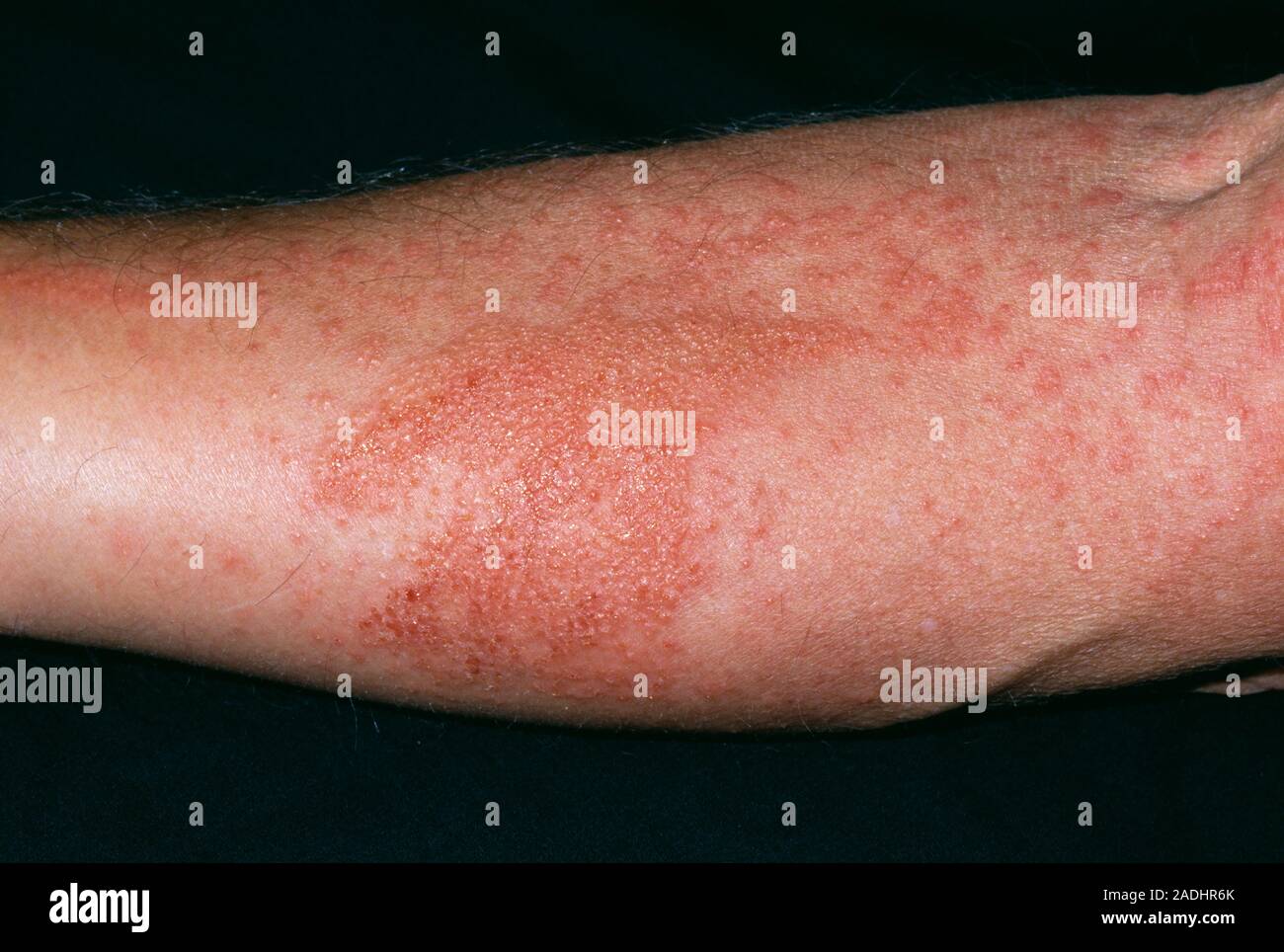 Nettle rash. 2-day-old urticaria on a 66-year-old man's arm. Urticaria ...