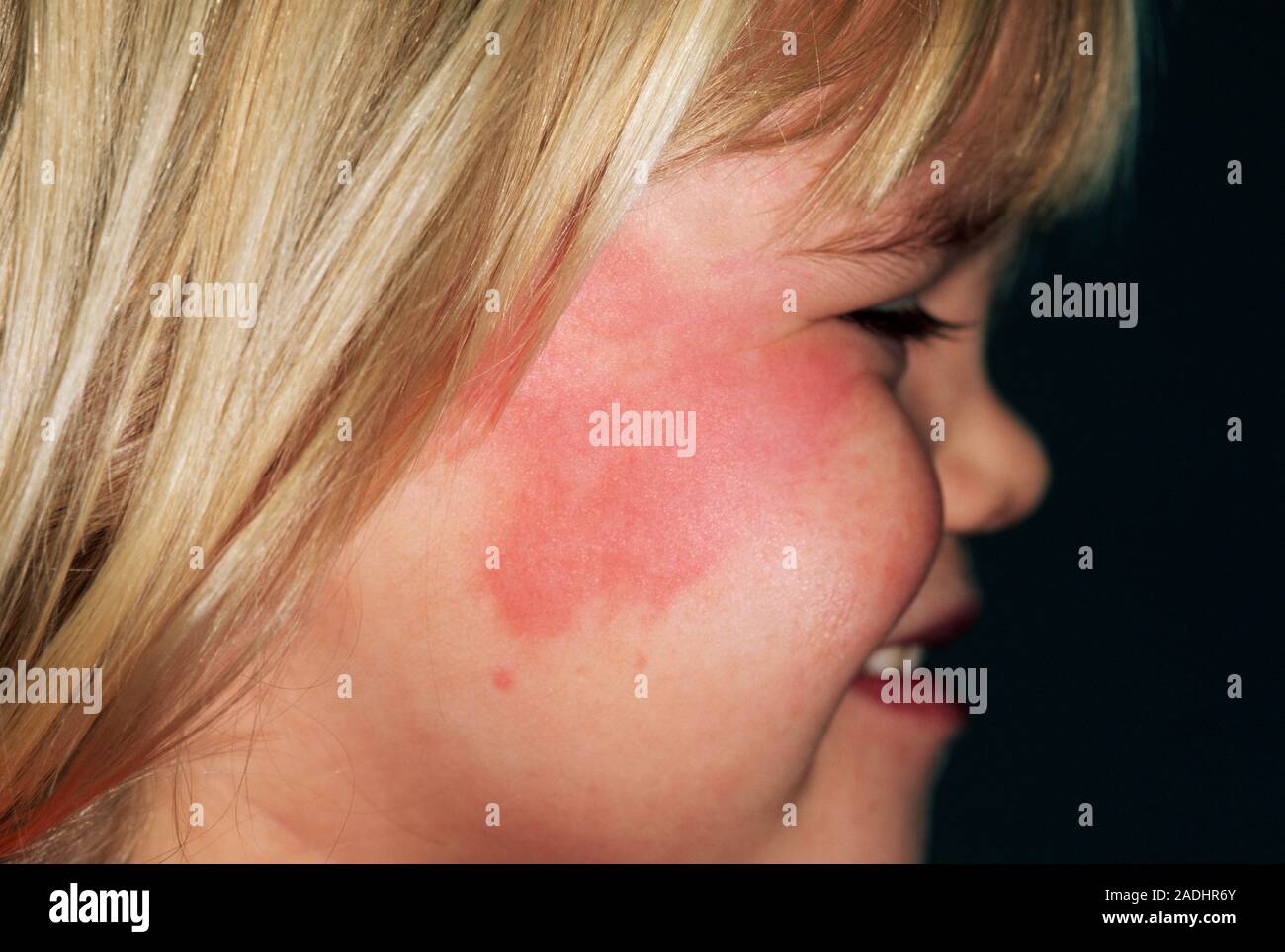 Urticaria rash. Itchy, red rash (weals) on the face of a three-year-old ...