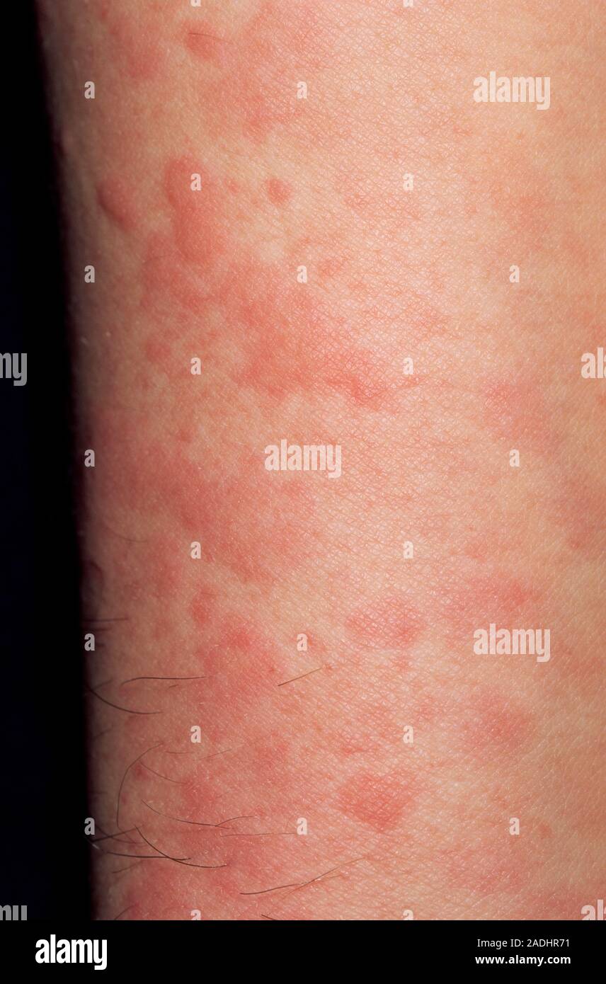 Urticaria reaction. Itchy, red rash (weals) on the leg of a 45-year-old ...