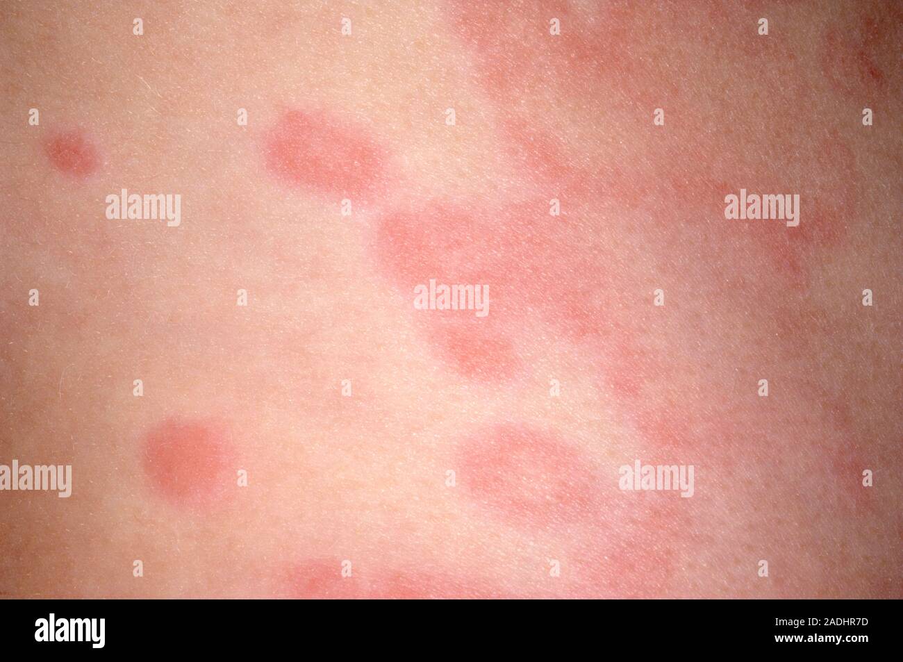 Hives. Weals on the skin of a 5 year old girl caused by urticaria. Urticaria, also known as ...