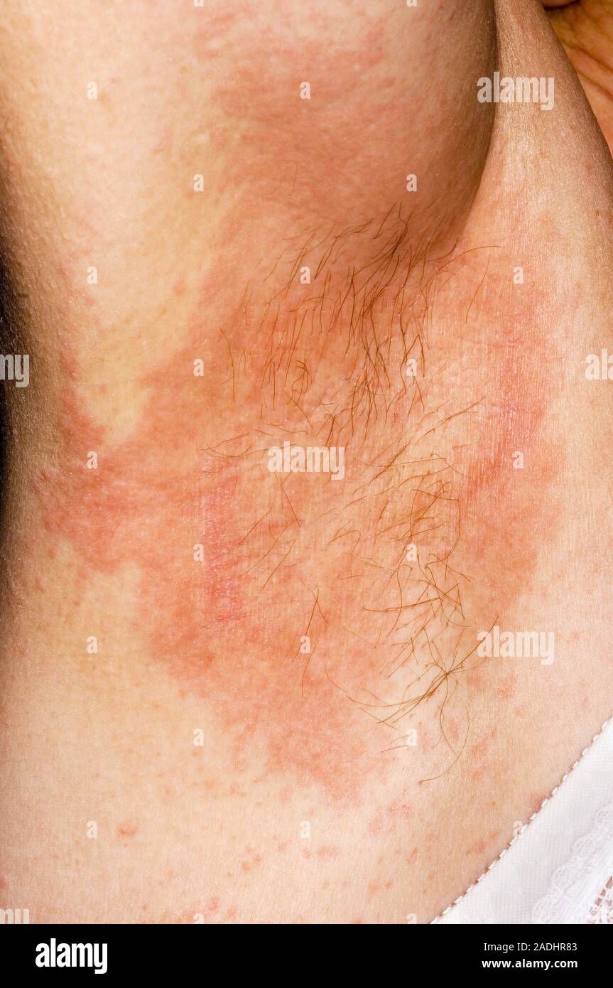 Urticaria rash (reddened areas) on a 58-year-old woman's armpit. Also ...
