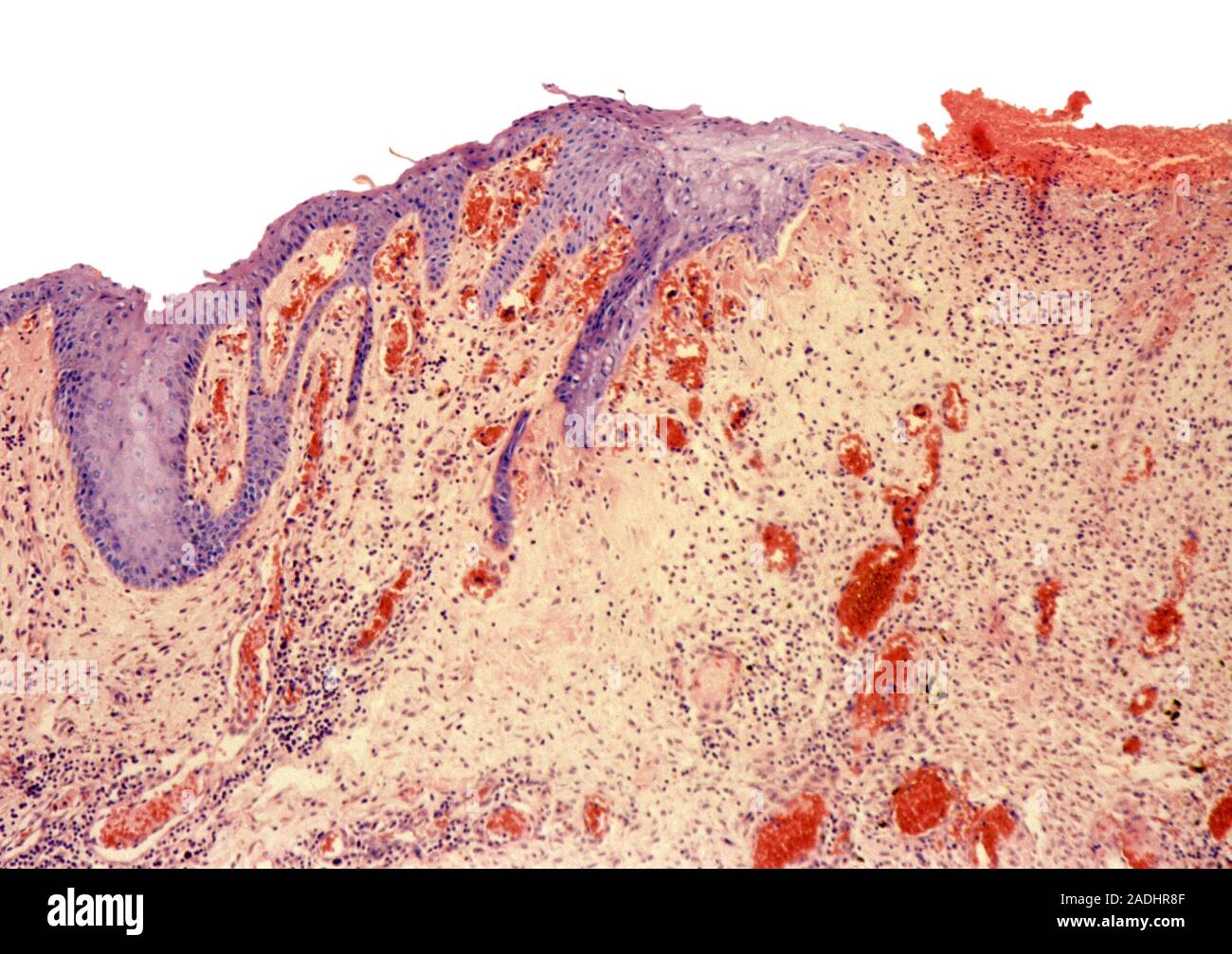 Healing skin ulcer. Coloured light micrograph of stratified squamous ...