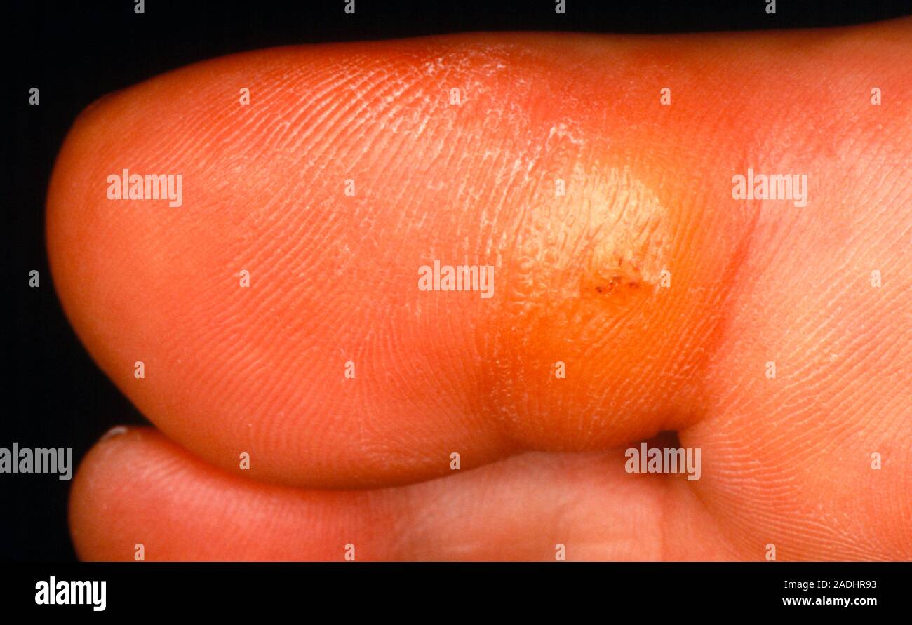 Verruca (plantar wart) on the big toe, contracted through the use of ...