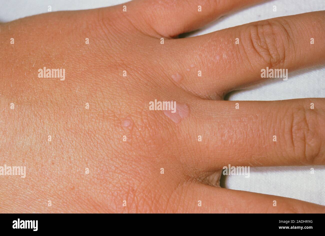 Common warts (verrucae) on a hand. Warts are caused by infection with ...
