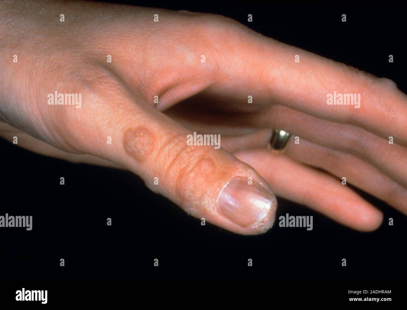 Warts on a young woman's thumb (medical name verruca). Warts are caused ...